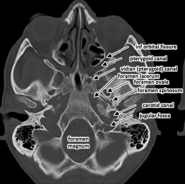 Cranial Bone Anatomy Ct Axial