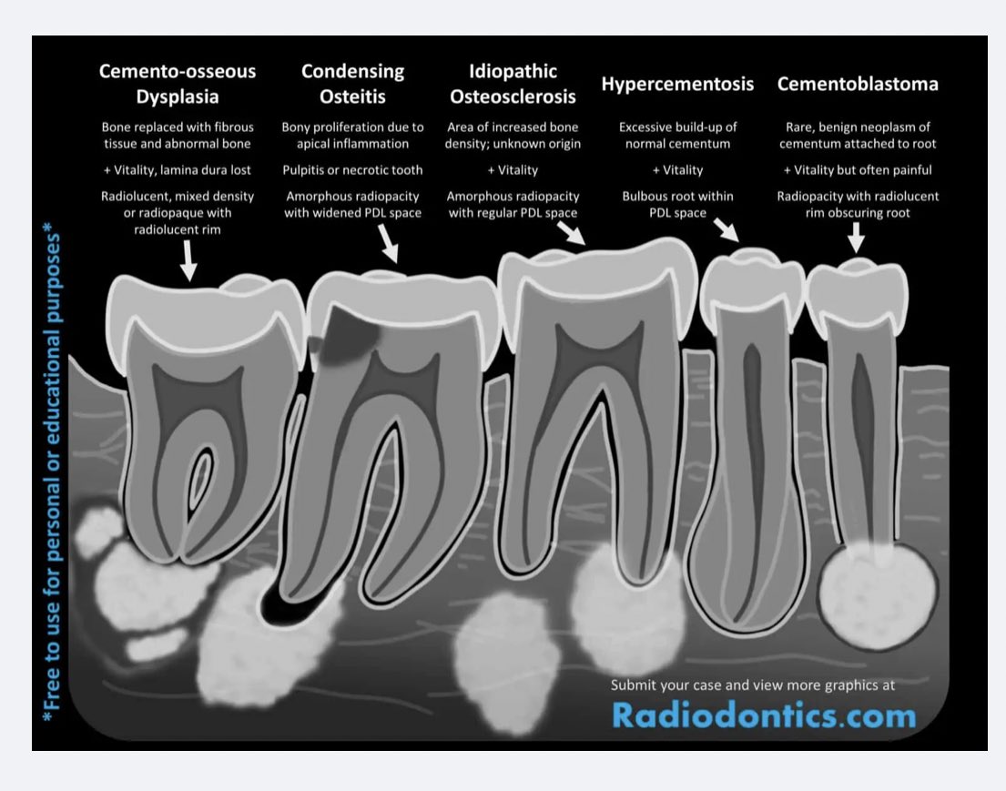 Cementoblastoma Vs Hypercementosis
