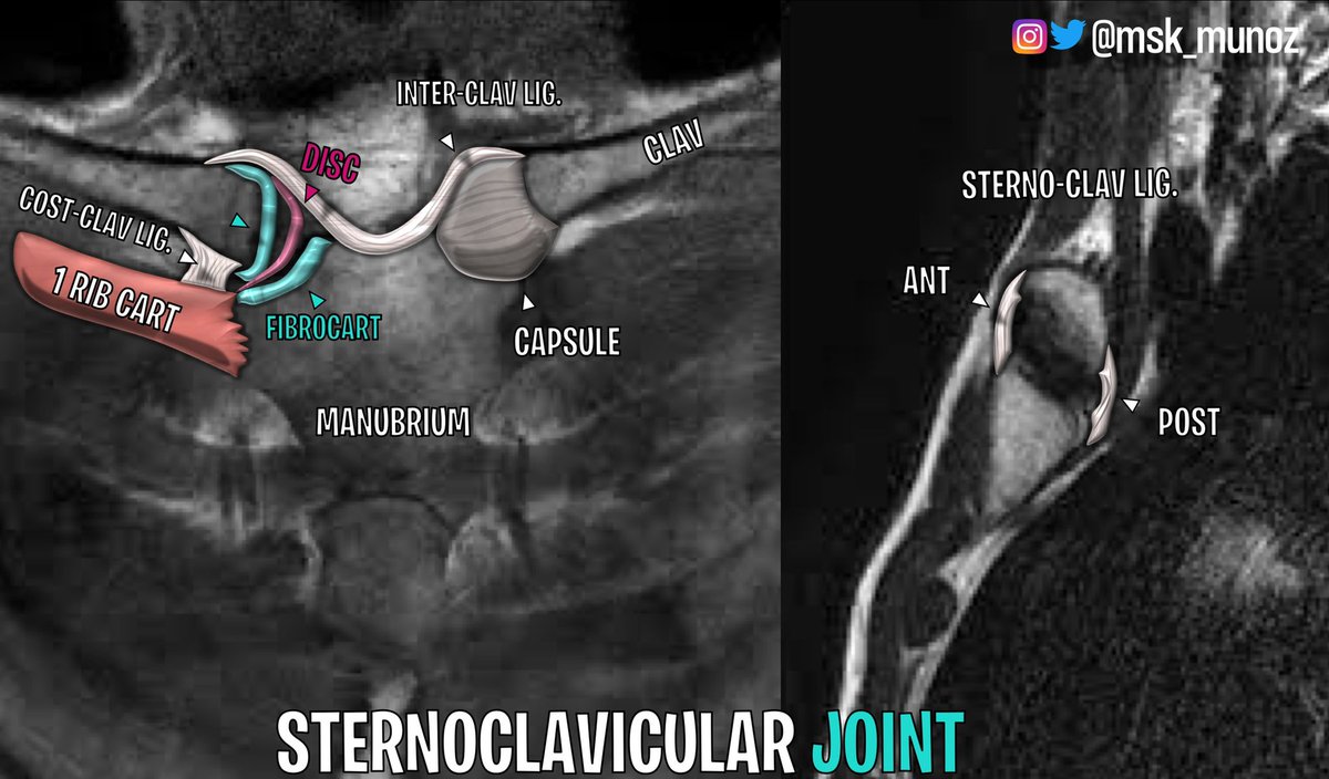 Articular Disc Of Sternoclavicular Joint Clavicle And Sternoclavicular
