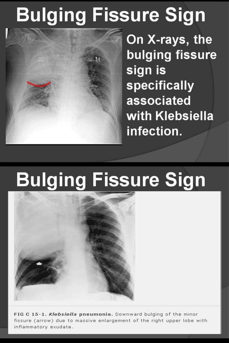 Bulging Fissure Sign