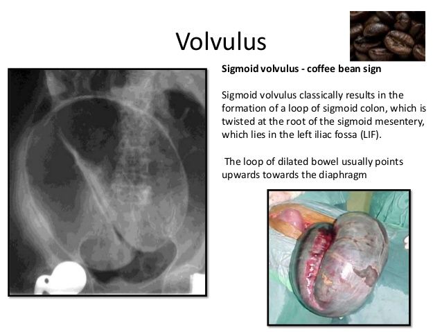 Sigmoid Volvulus Decompression