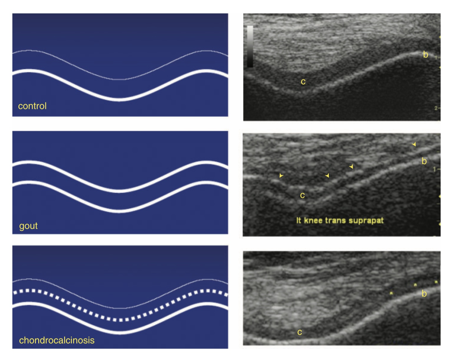 Chondrocalcinosis Vs Normal