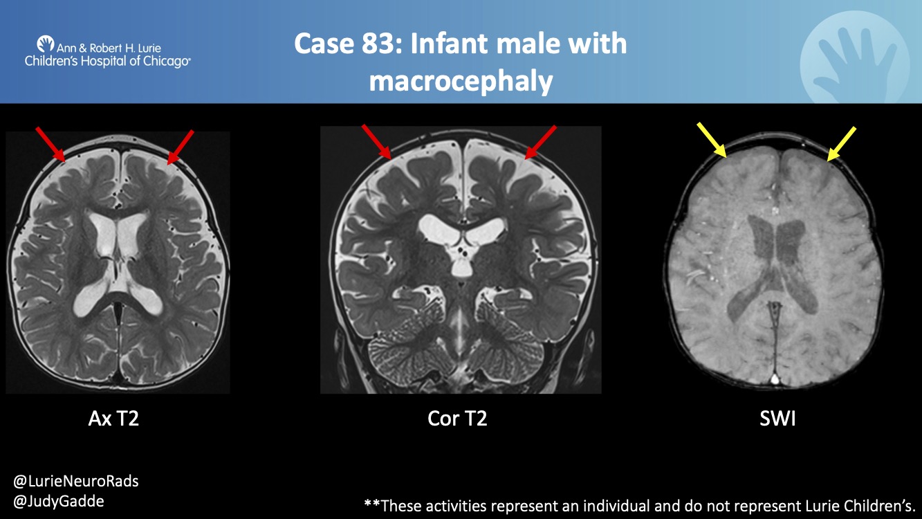 Macrocephaly Mri