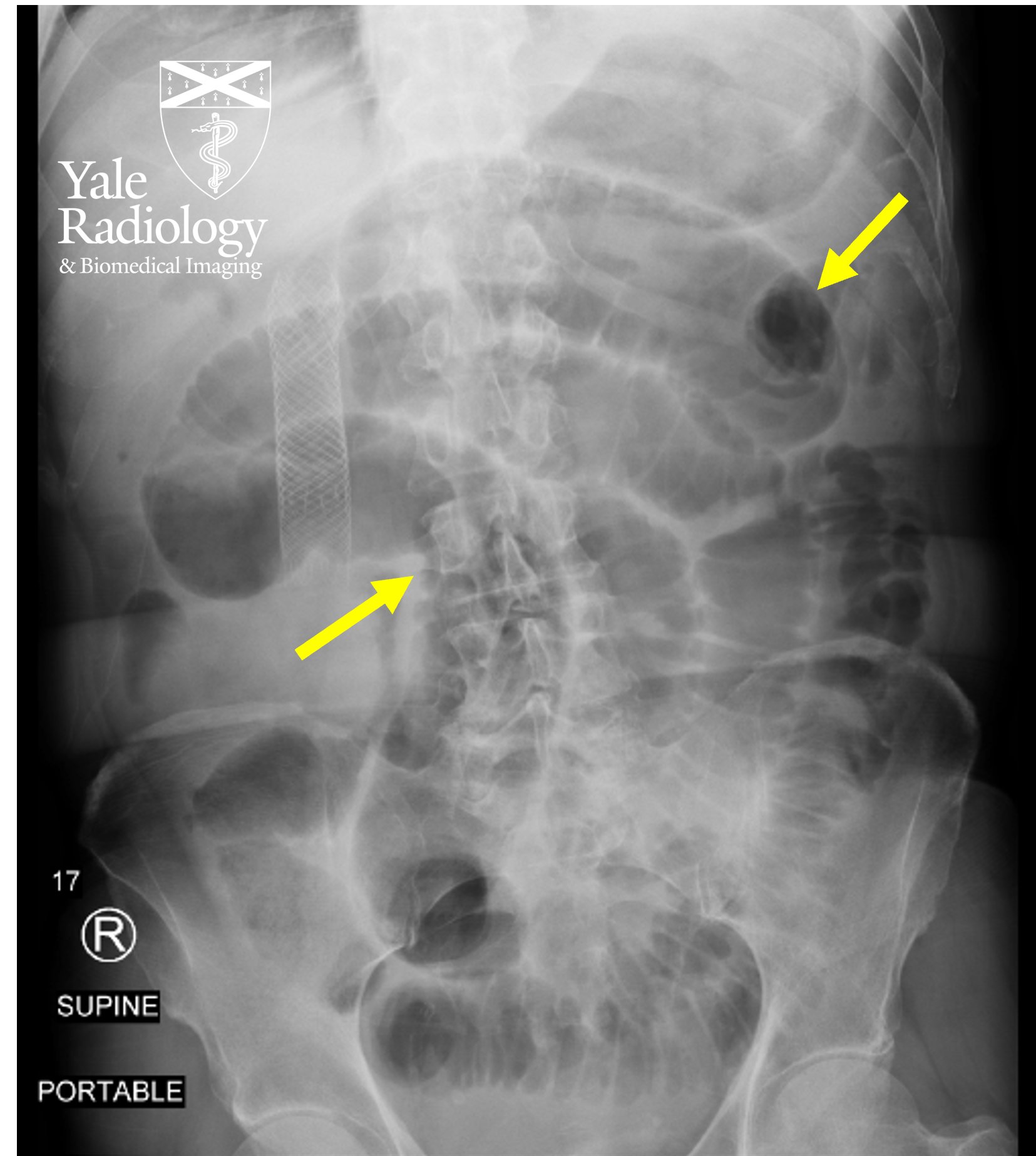 Small Bowel Obstruction X Ray