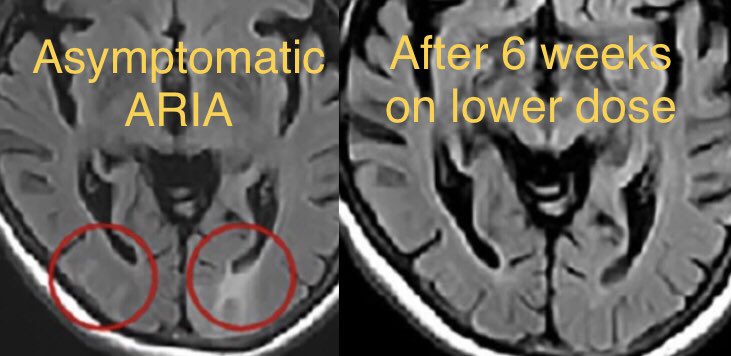 1/ARIA isn’t just for operas or Vegas hotels! This is ARIA (amyloid ...
