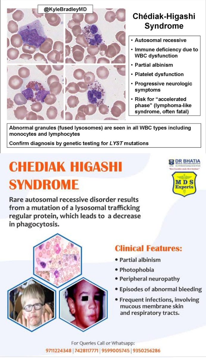 Chediak Higashi Albinism