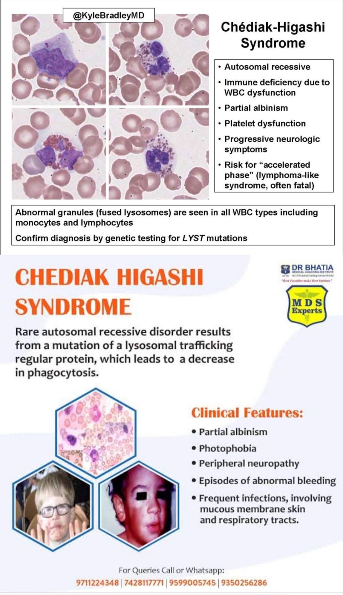 Oculocutaneous Albinism Chediak Higashi