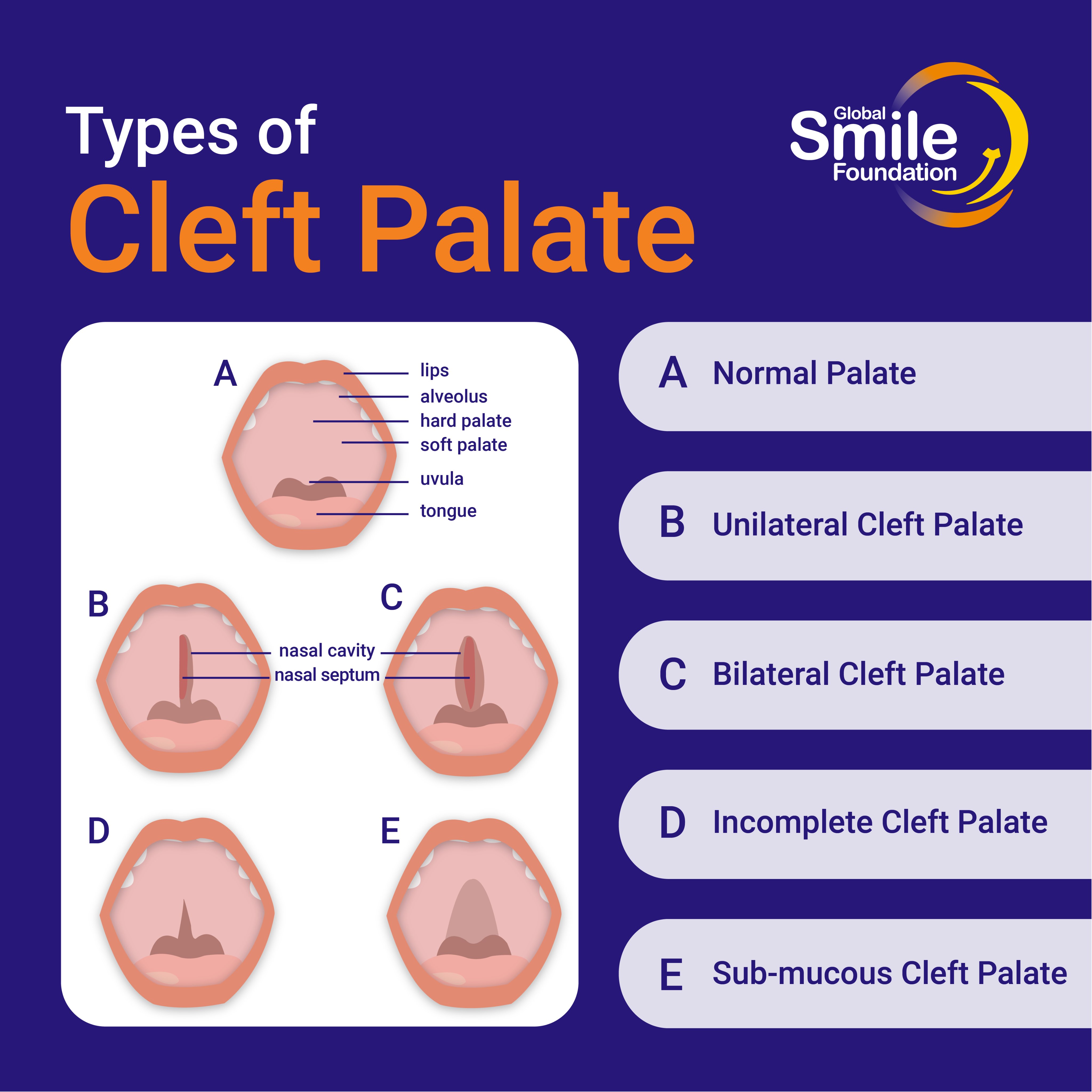 Types Of Cleft Palate