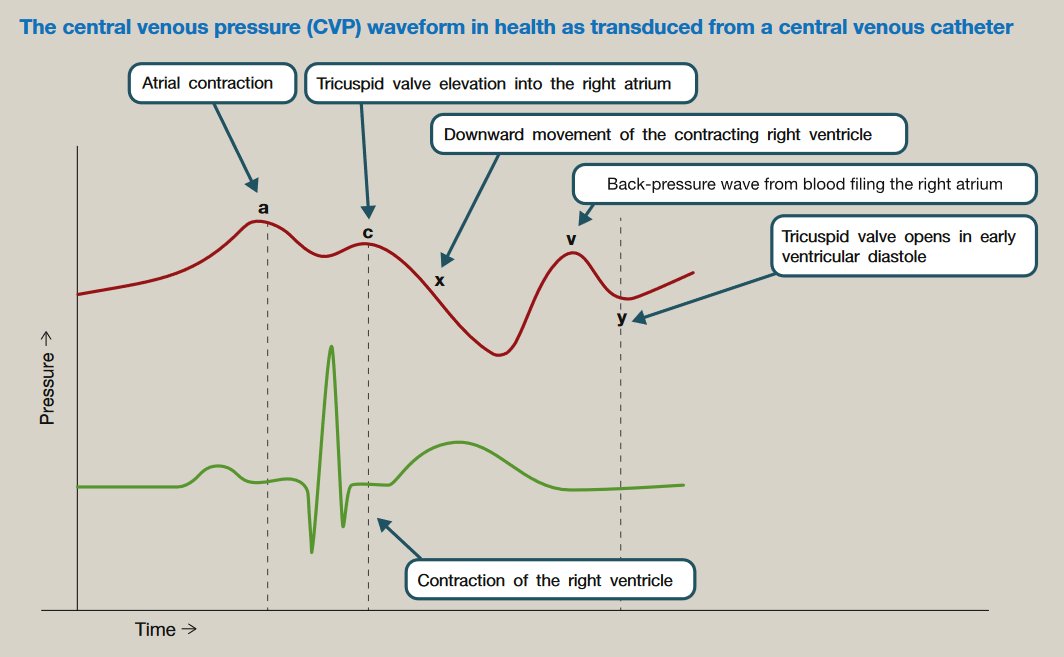 RA/CVP Waveform Interpretation Central Venous Pressure, 56% OFF