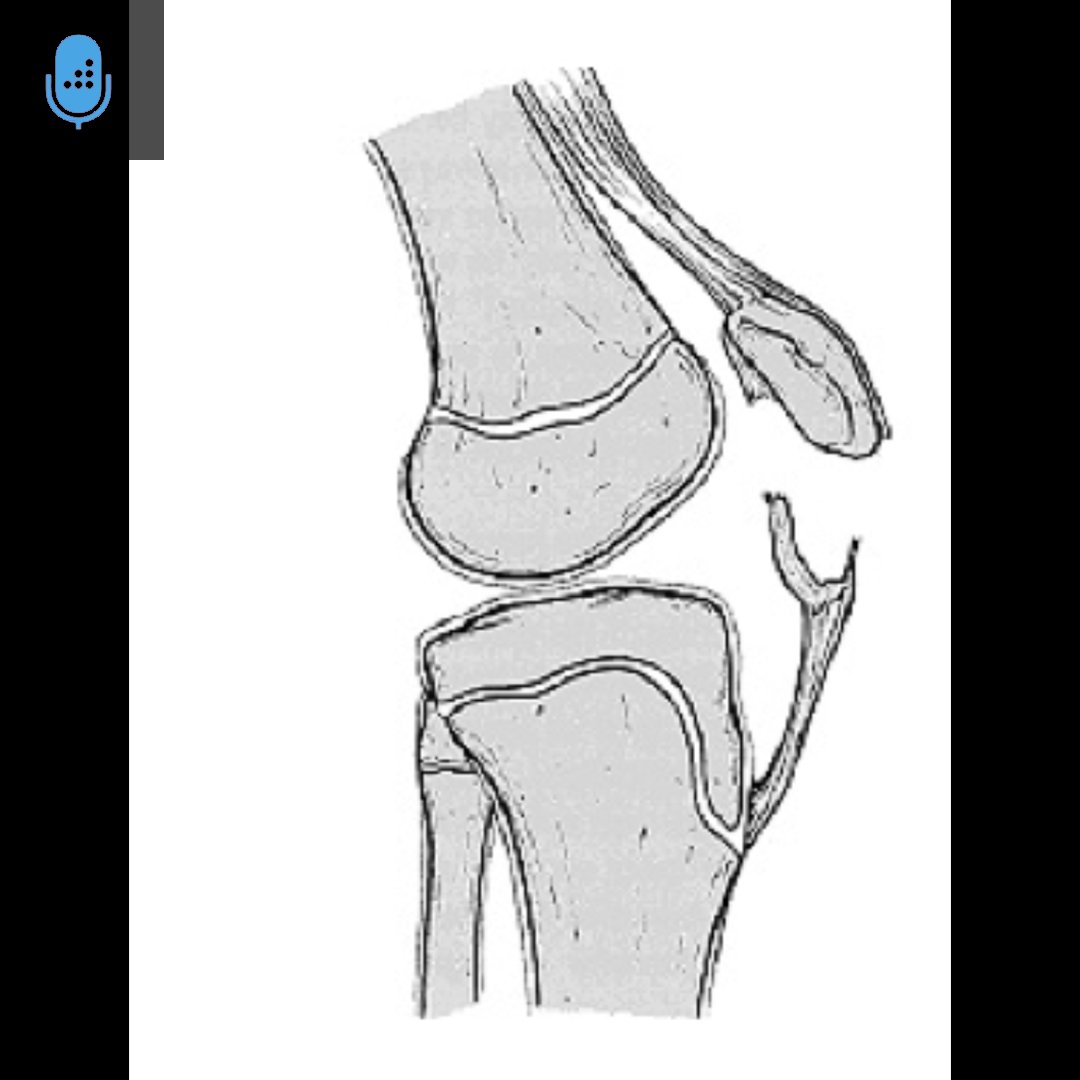 Orthobullets on Twitter: "Patellar Sleeve Fractures are rare injuries seen in children between 8 ...