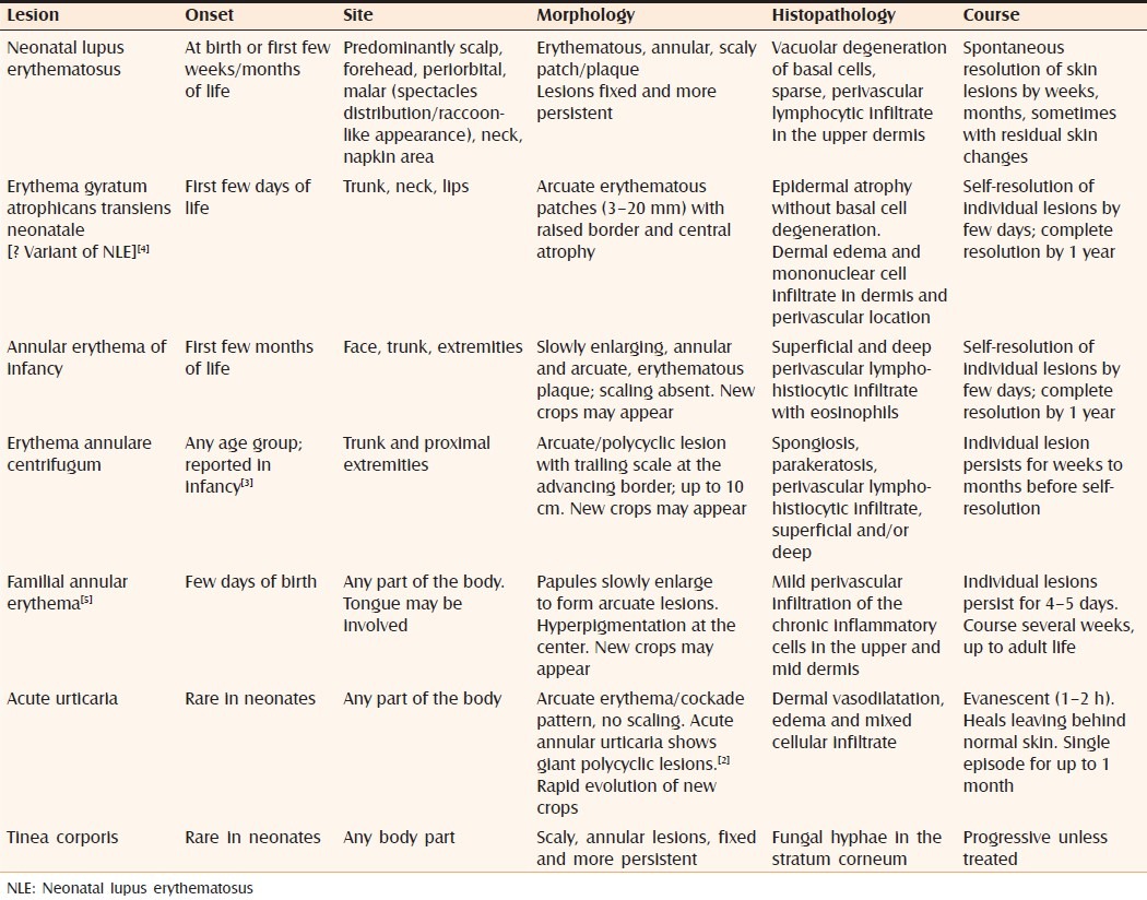 Erythema Chronicum Migrans Vs Erythema Multiforme