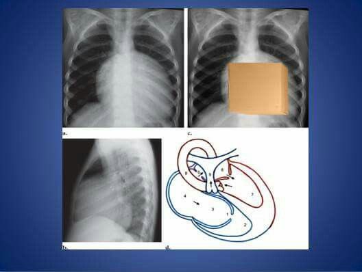 Ebstein Anomaly Radiology Acute Right Ventricular Reshaping After