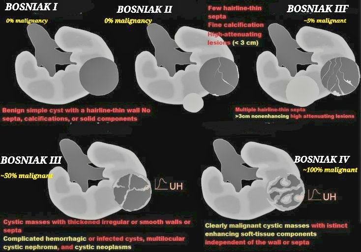 Classification Of Renal Cysts
