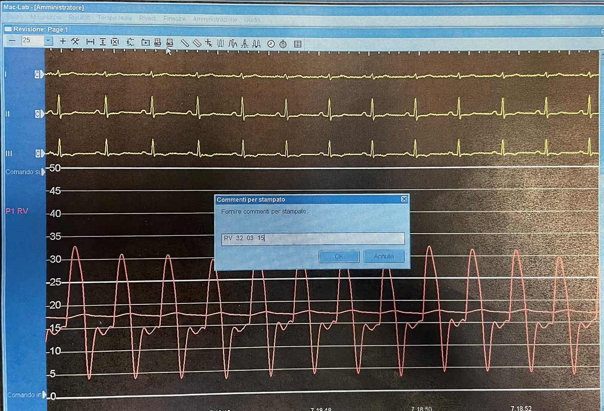 🧵👇 70 y F, affected by GPA (granulomatosis with poliangiitis called ...