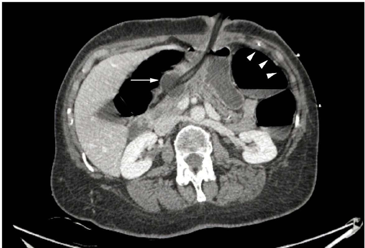 You may have seen the 🧵on nonurologic uses of Foley catheters - head ...