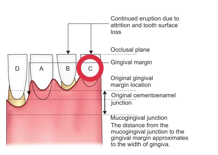 Cementoenamel Junction