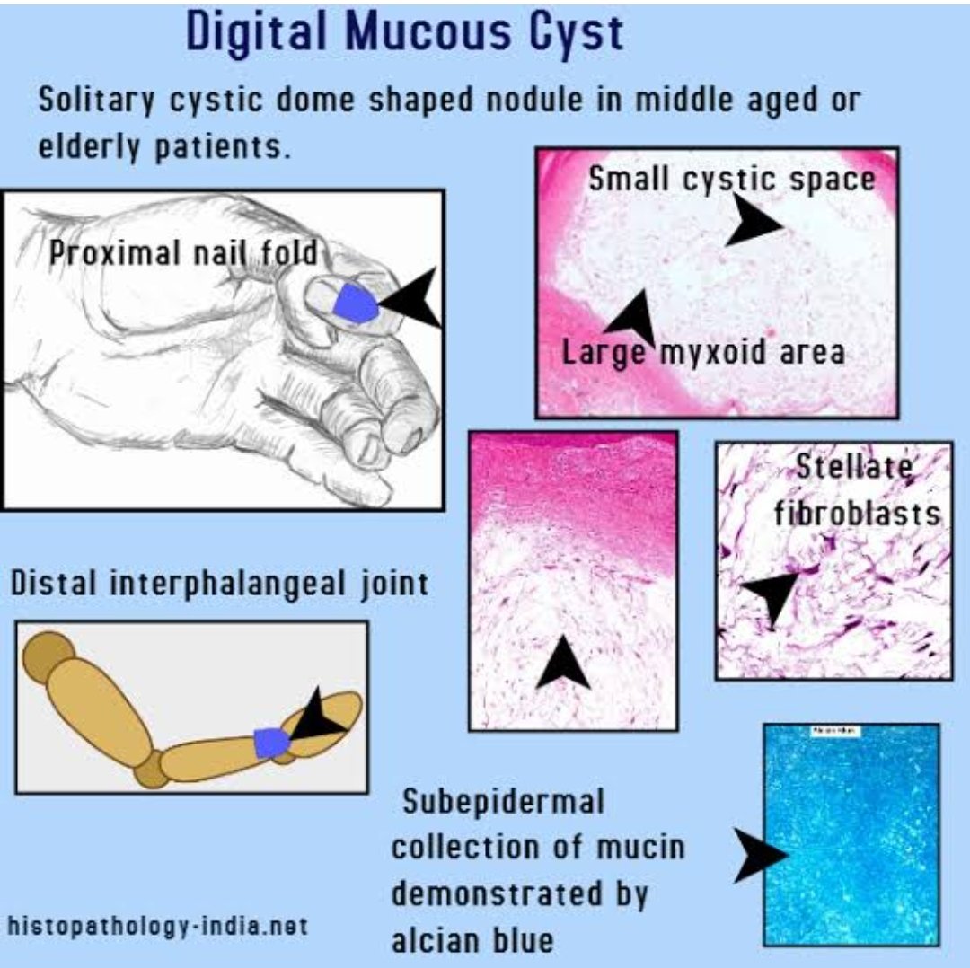 Digital Mucous Cyst