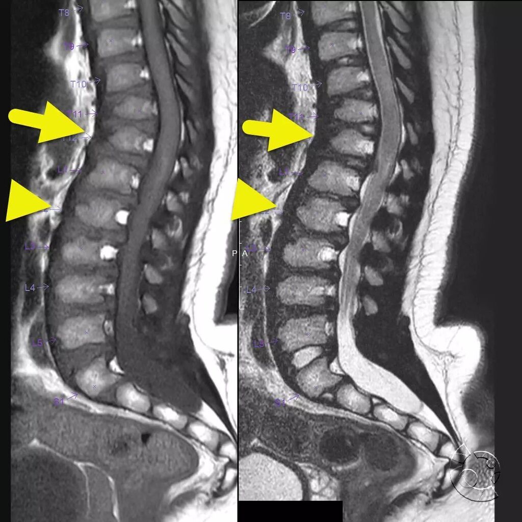 Hurler Syndrome X Ray