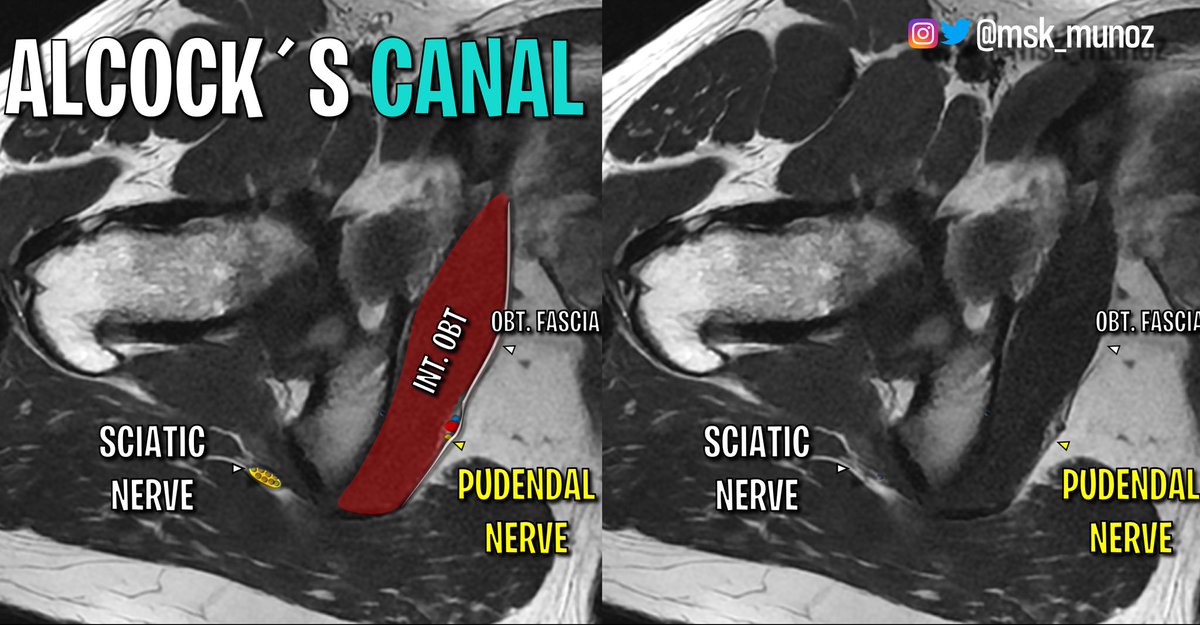 Pudendal Nerve Mri