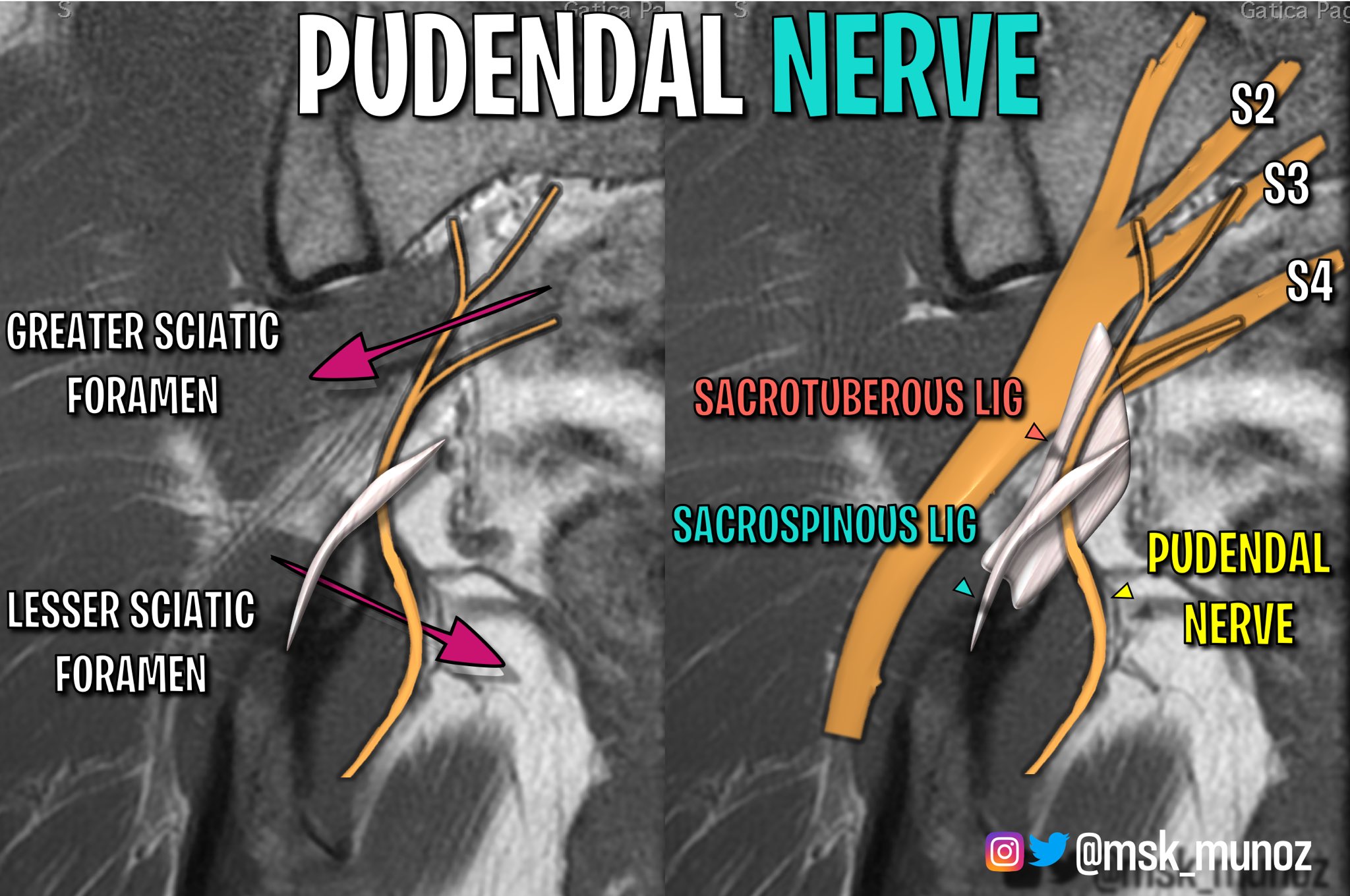 Pudendal Nerve Mri