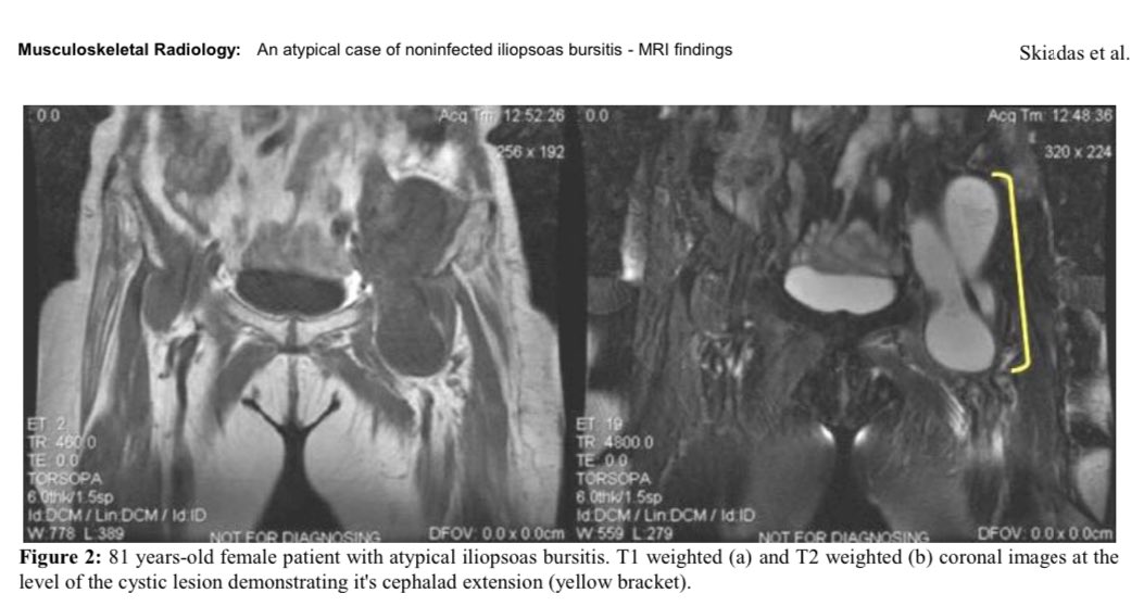 Iliopsoas Bursitis Mri