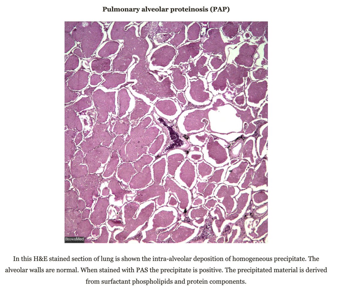 🪟 Pulmonary Alveolar Proteinosis (PAP) 🪟 - Rare cause of insidious ...