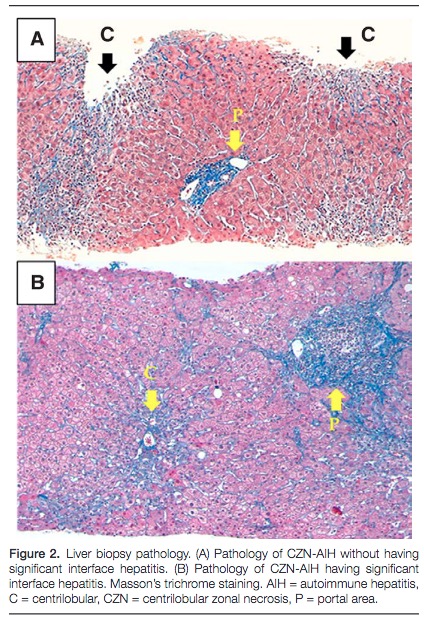 Centrilobular Necrosis