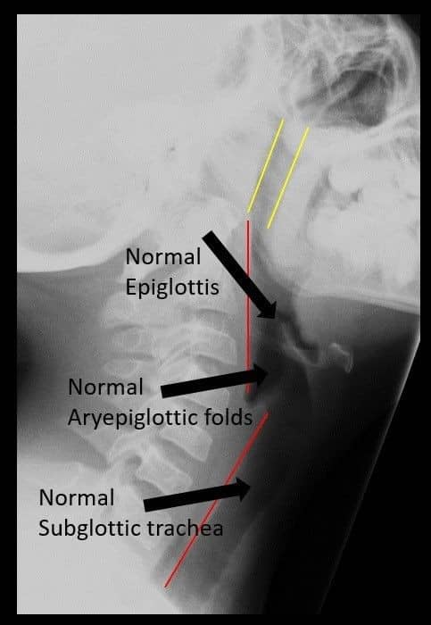 Normal Epiglottis X Ray Rapid Review: Epiglottitis RoshReview.com