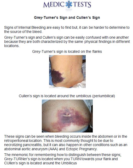 Periumbilical Cullen Sign