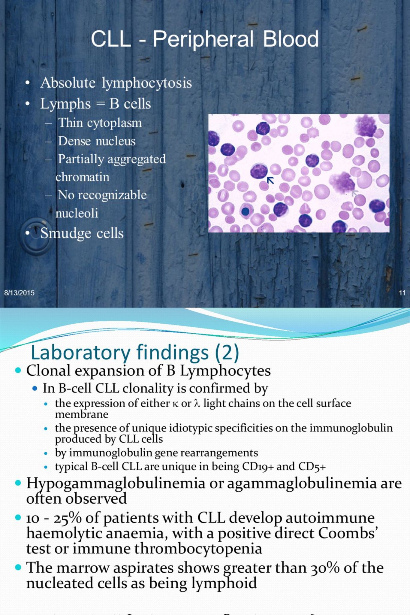 Chronic Lymphocytic Leukemia Smudge Cells