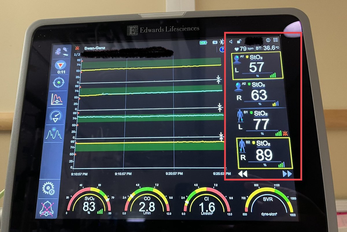 Here’s a fun ECMO teaching case: A patient undergoing VA ECMO has these ...