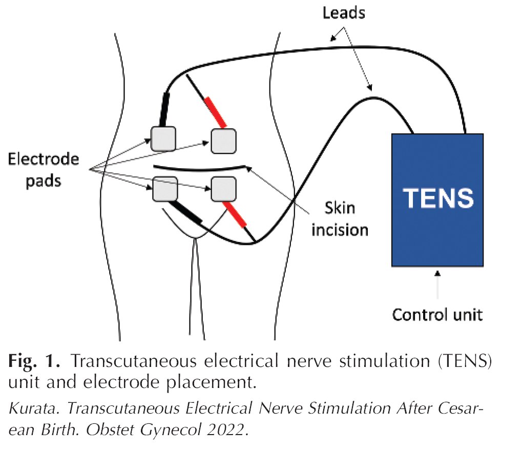 Transcutaneous Electrical Nerve Stimulation