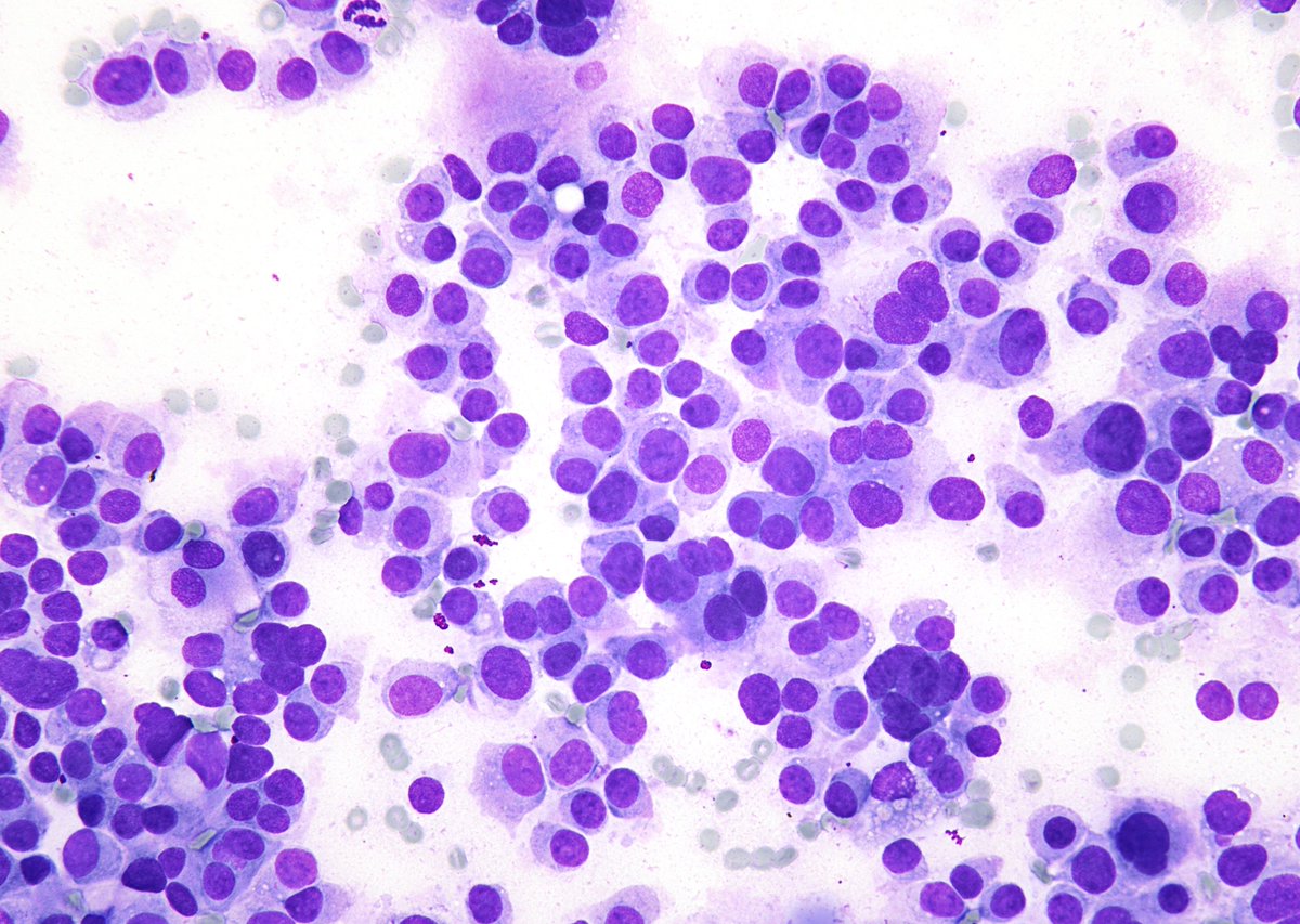 Medullary Carcinoma Cytology