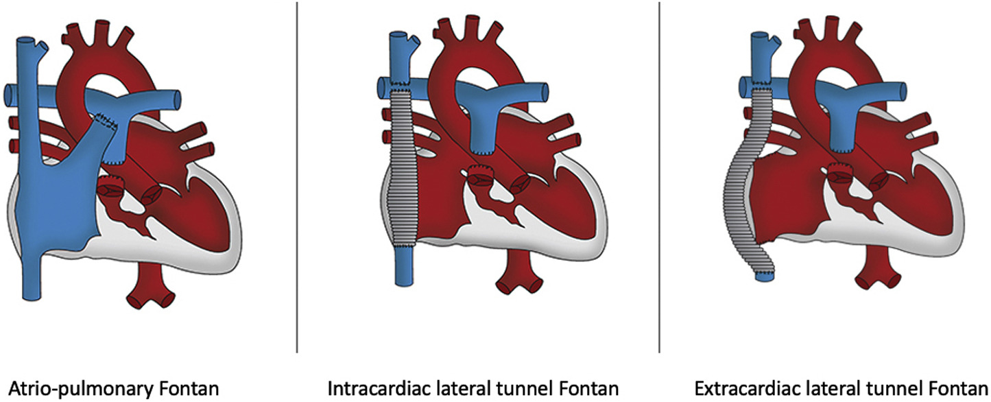 Lateral Fontan