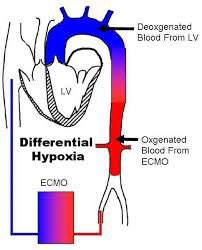 Here’s a fun ECMO teaching case: A patient undergoing VA ECMO has these ...
