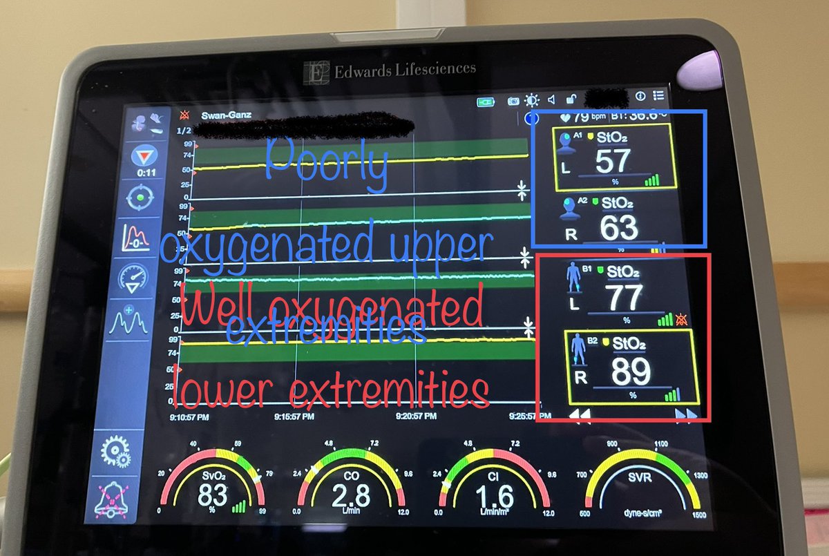 Here’s a fun ECMO teaching case: A patient undergoing VA ECMO has these ...