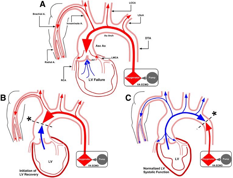 Here’s a fun ECMO teaching case: A patient undergoing VA ECMO has these ...