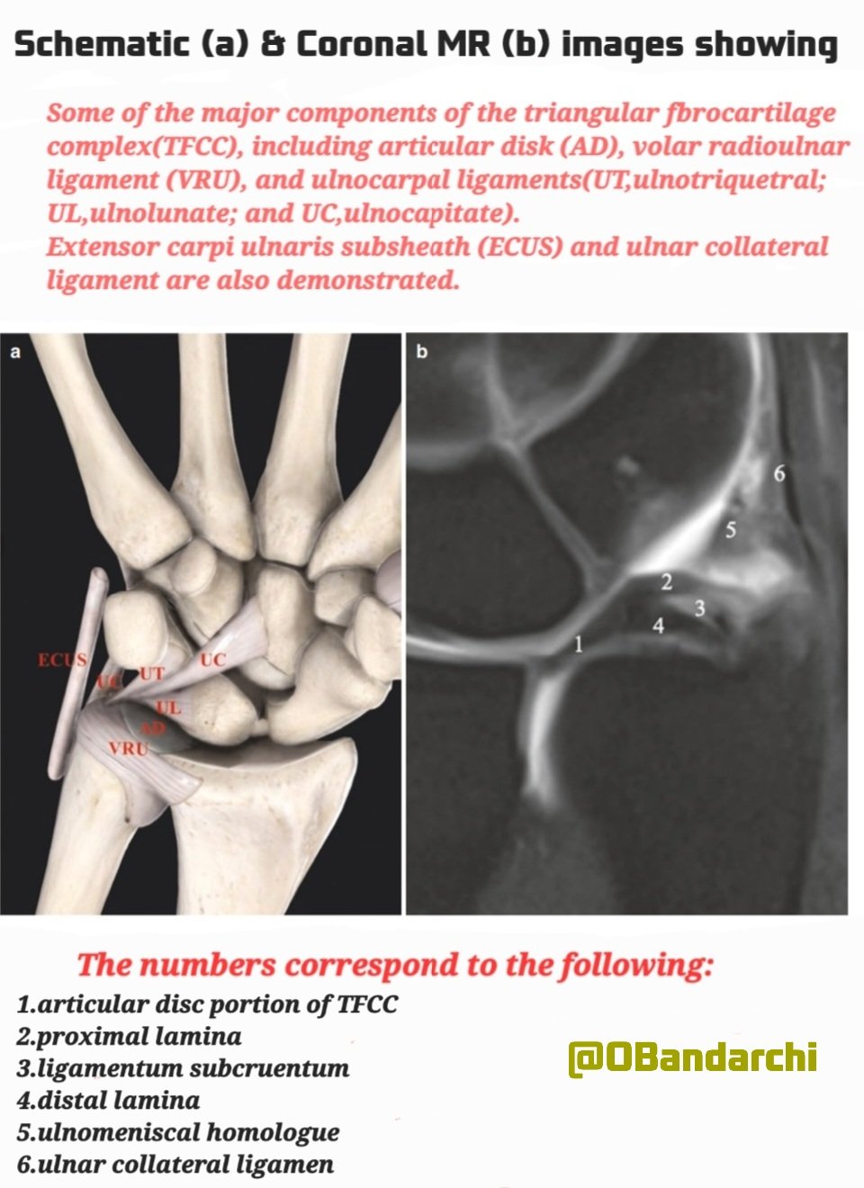 Triangular Fibrocartilage Complex