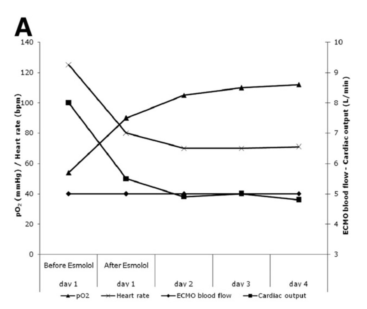 Here’s a fun ECMO teaching case: A patient undergoing VA ECMO has these ...