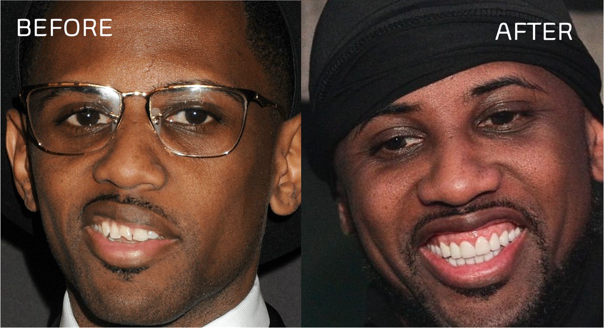 Nas Chipped Tooth