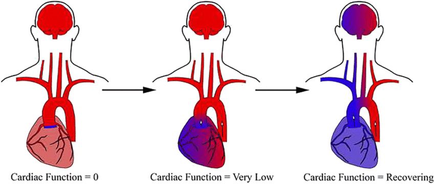 Here’s a fun ECMO teaching case: A patient undergoing VA ECMO has these ...