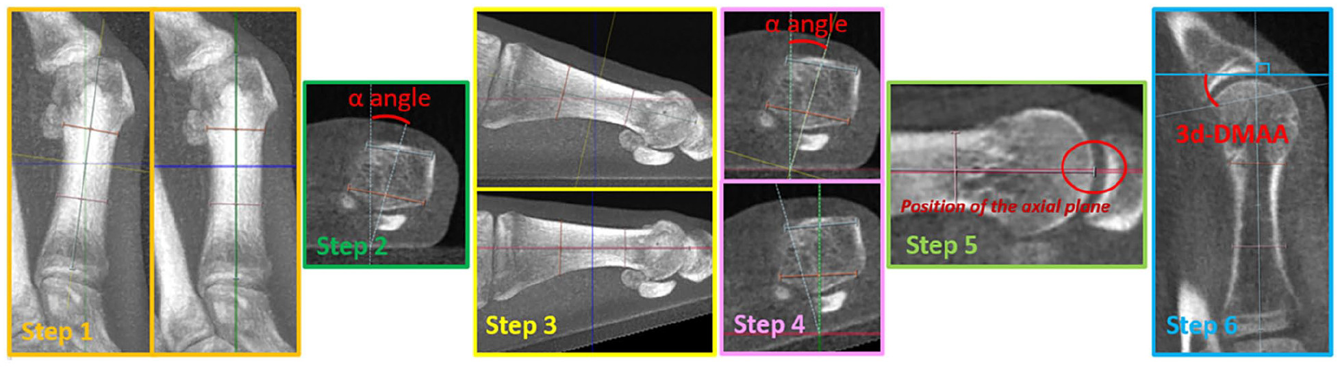 Distal Metatarsal Articular Angle