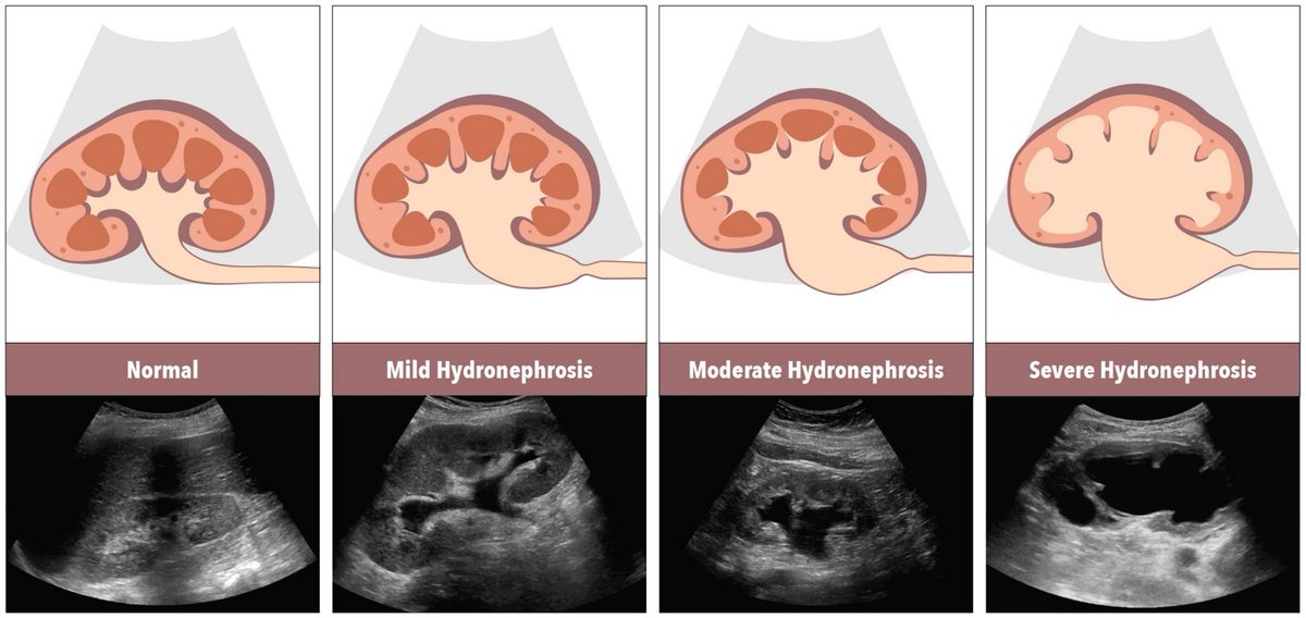Hydronephrosis Grading Ultrasound
