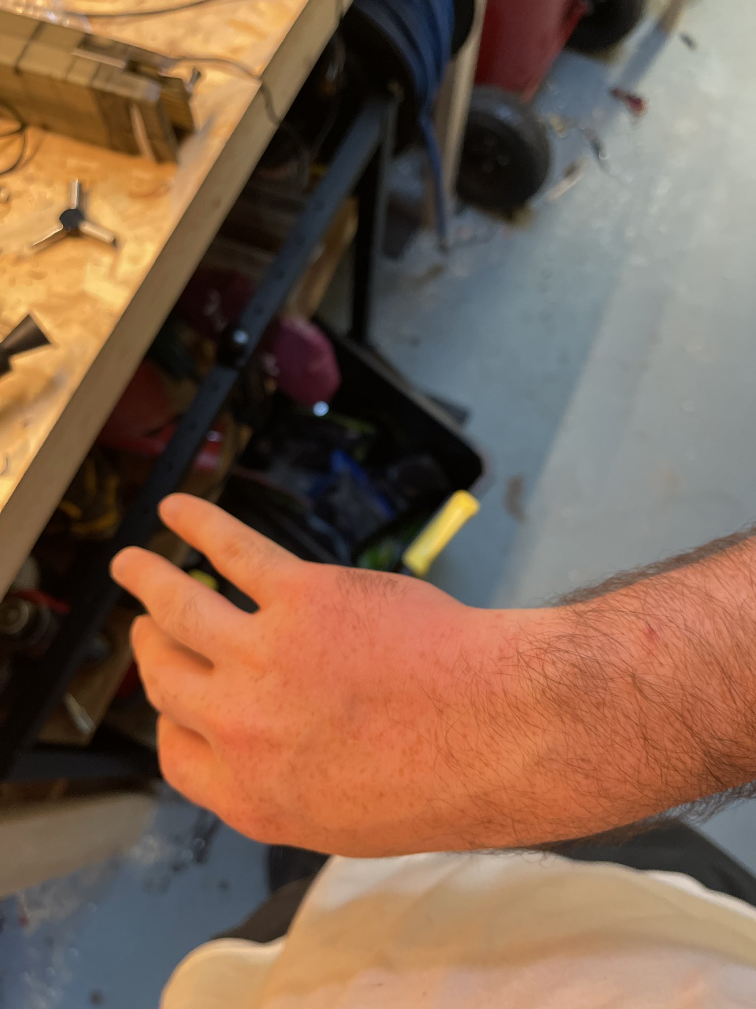 Sean - Forge Labs on Twitter: "My hand is swelling are you joking me https://t.co/rY0xqROULI ...