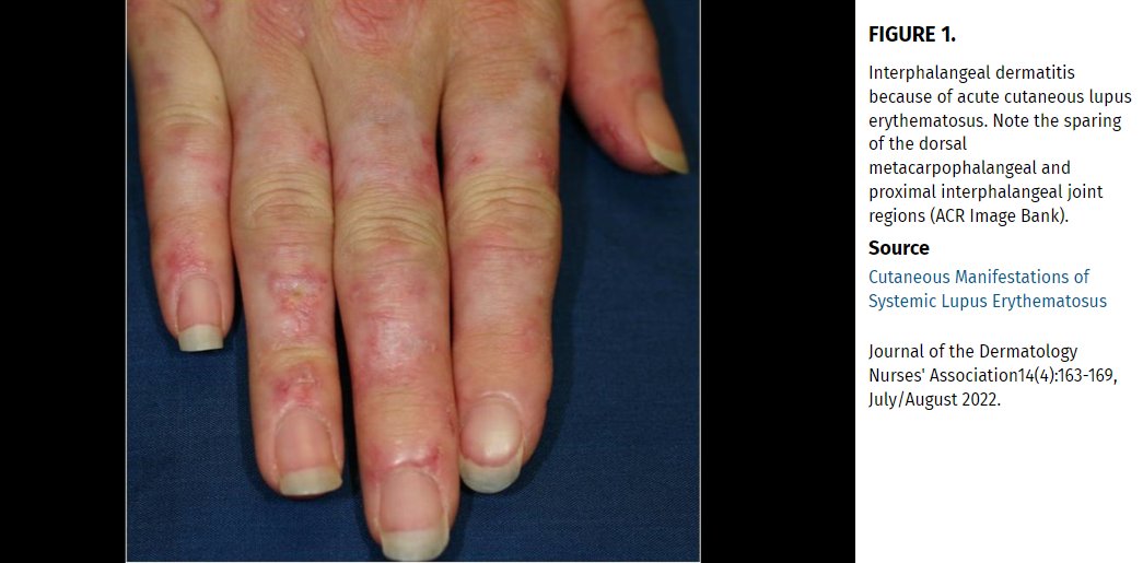 Systemic Lupus Erythematosus Hand
