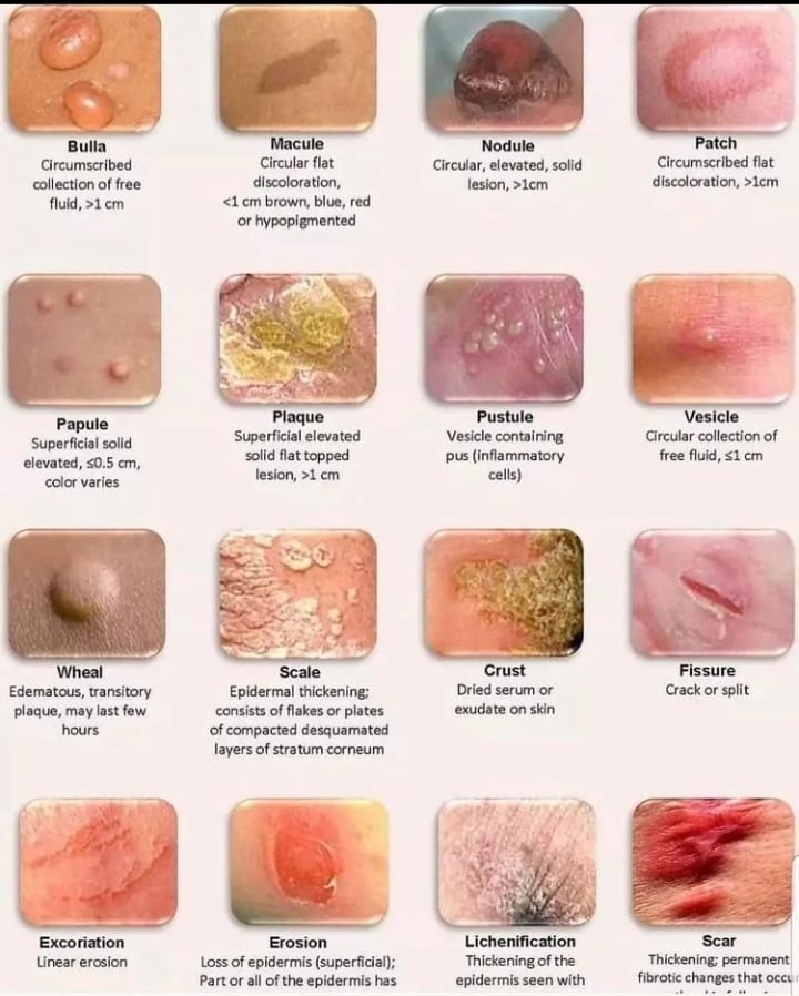 Pustule Vs Papule
