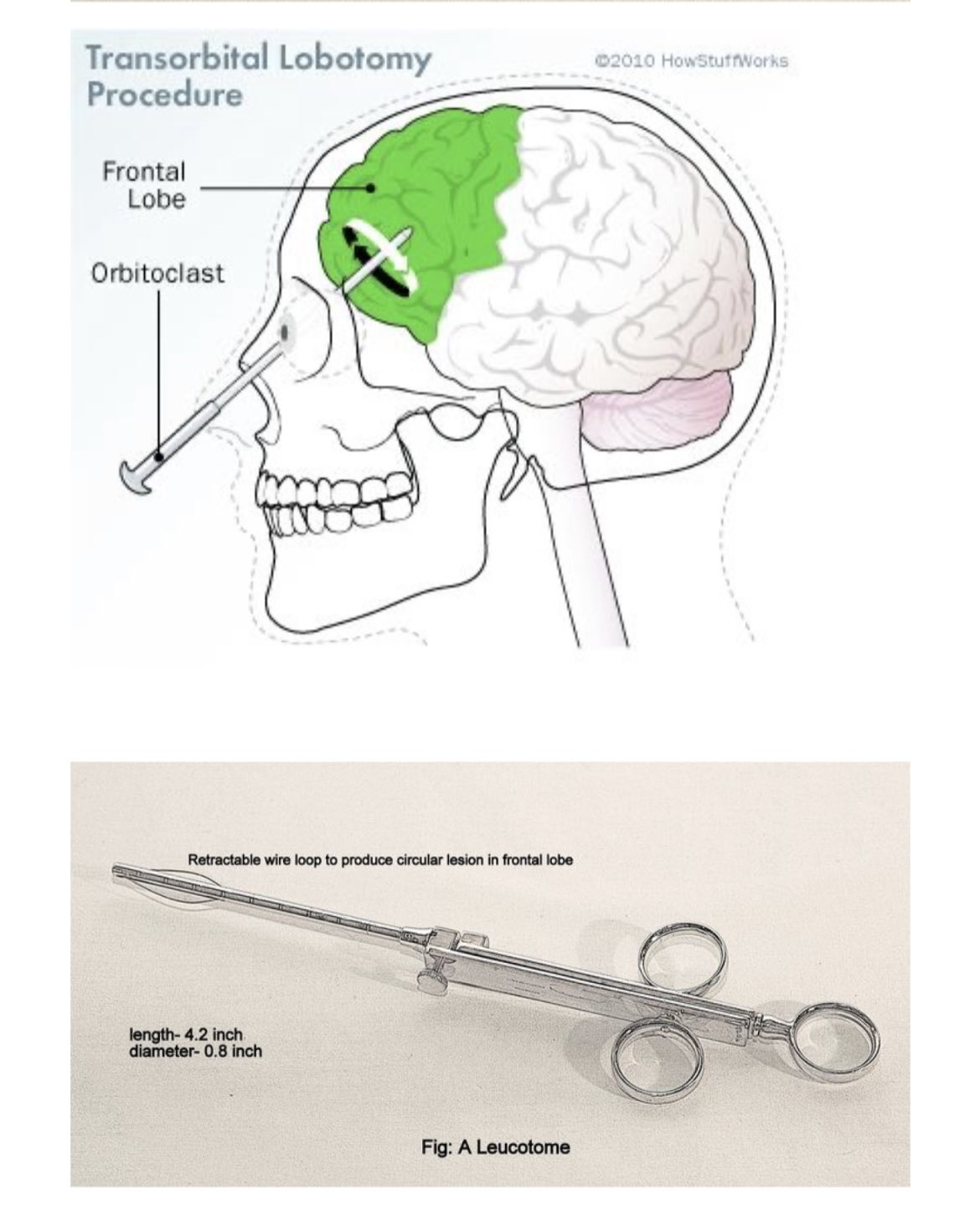Lobotomy Before And After Brain