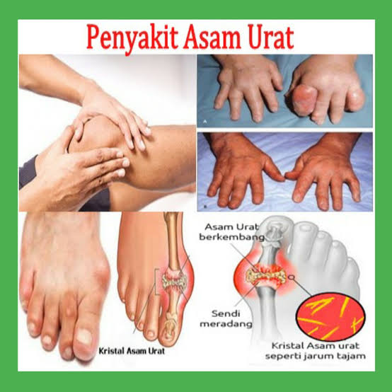 "Asam Urat dan Terapi nya" Sumber dr.agus rahmadi Allopurinol salah ...