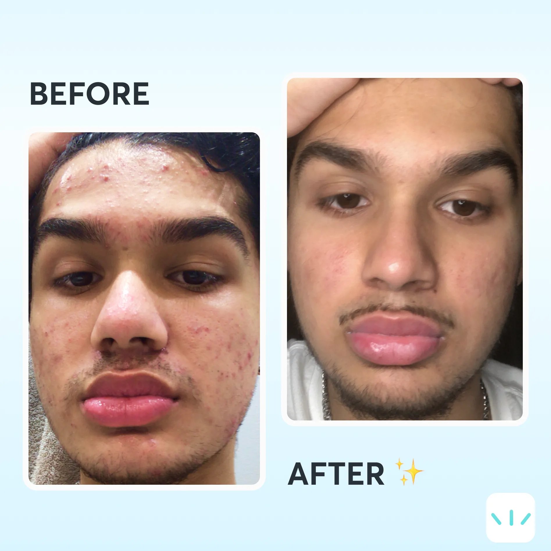 Dermatologist Before And After Acne