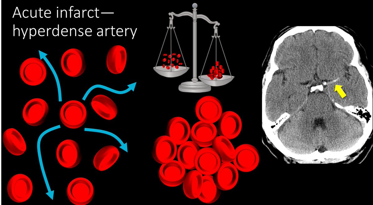 1/Time is brain! So you don’t have time to struggle w/that "stroke ...